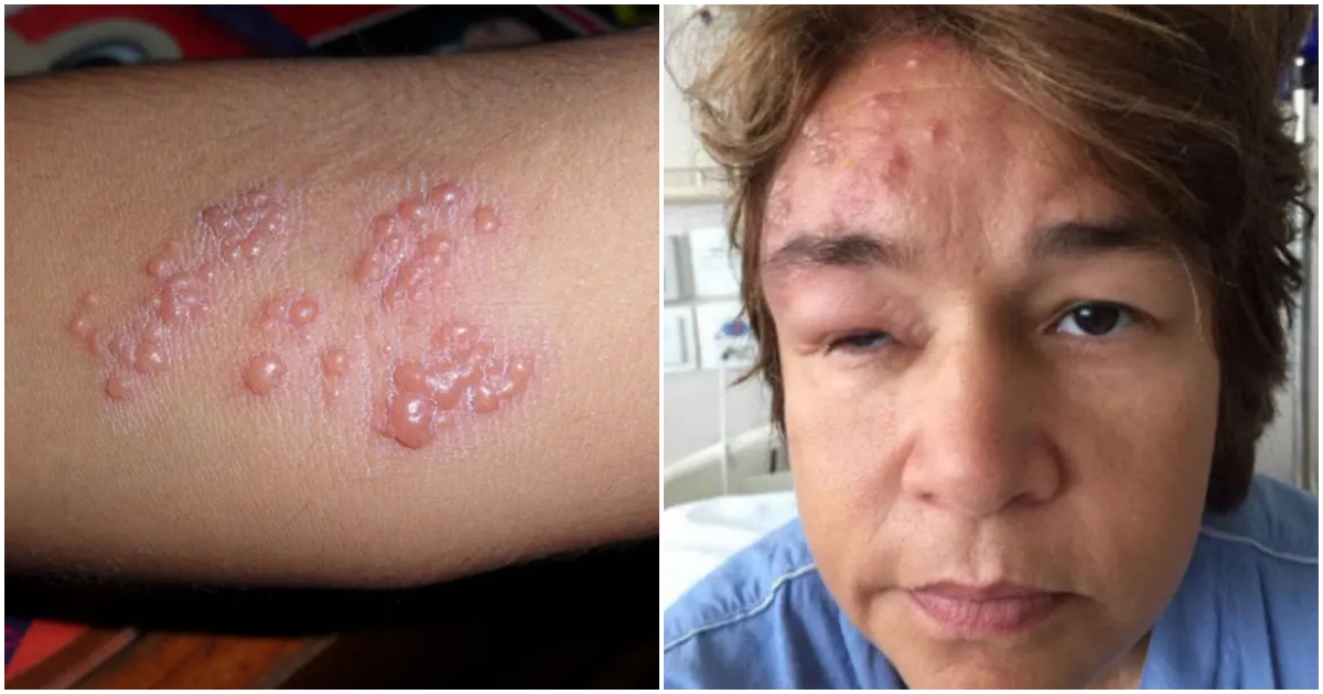 Jak správně postupovat při pásovém oparu | Světkreativity