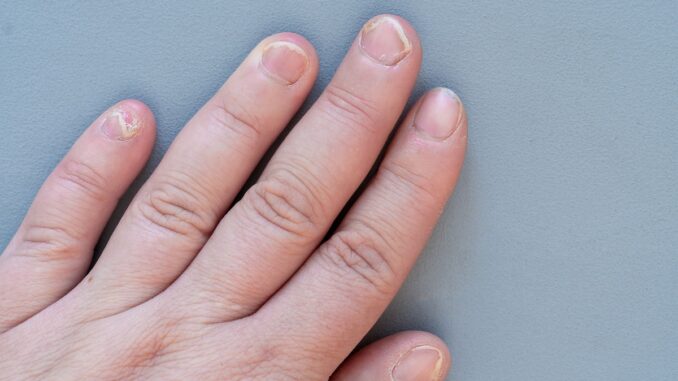Nepodceňujte rýhy na nehtech. Mohou signalizovat problém