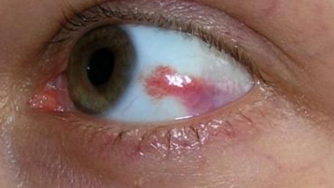 Na infarkt myokardu mohou upozornit i oči - Světkreativity