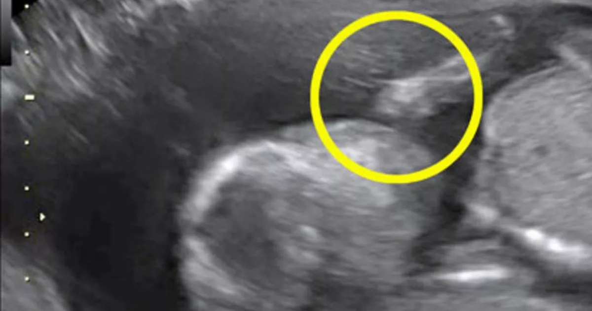 Při pohledu na ultrazvuk ji málem trefil šlak. Doktoři to viděli poprvé