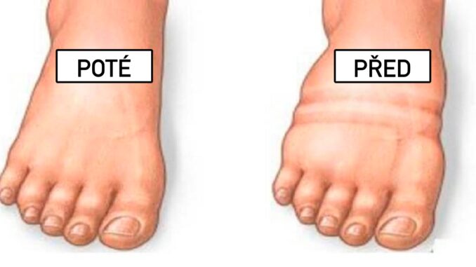 Zadržování vody: Pomocí této metody se zbavíte 99,8% tekutin